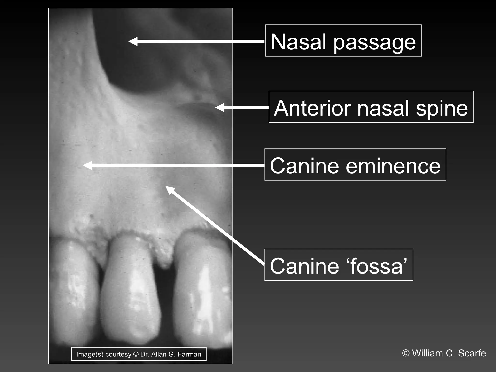 Dental Maxillary and Mandibular Anatomic Radiographic Landmarks.ppt | 3 ...