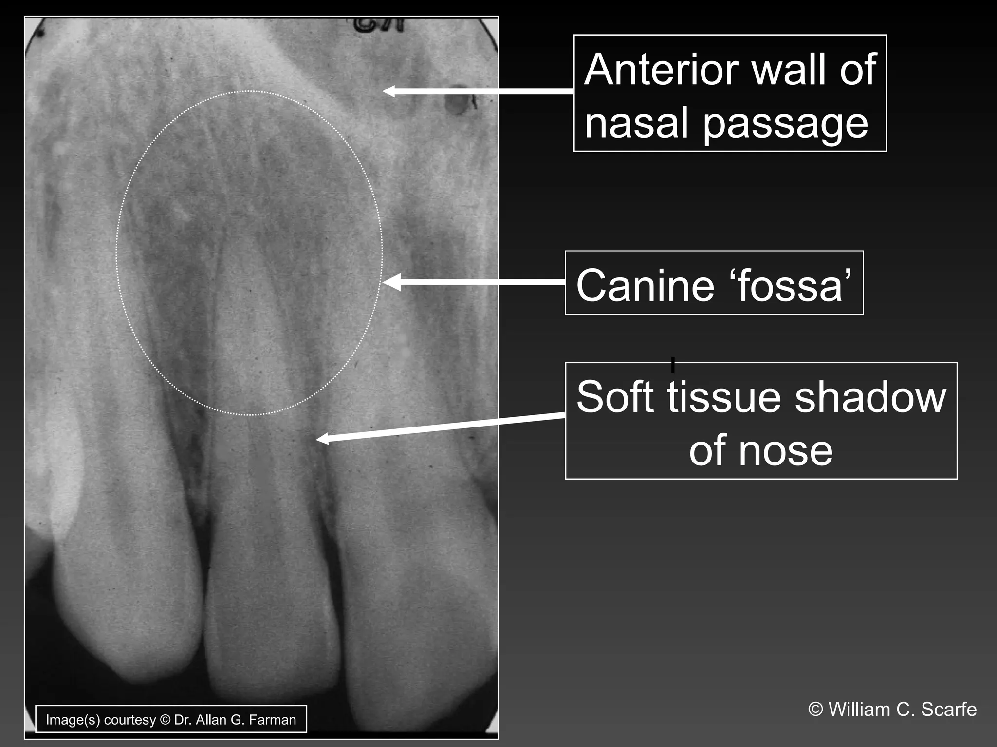 Dental Maxillary and Mandibular Anatomic Radiographic Landmarks.ppt