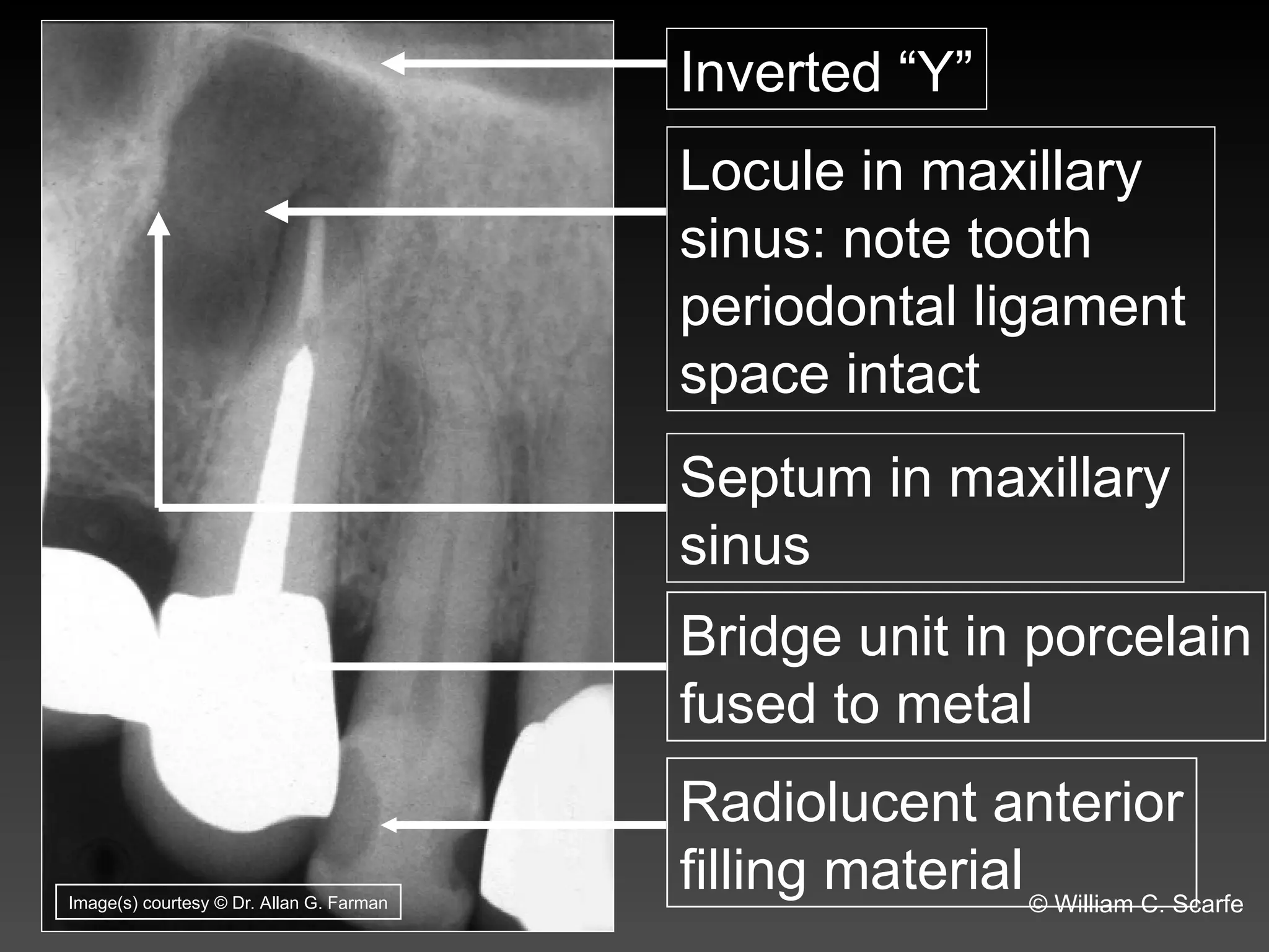 Dental Maxillary and Mandibular Anatomic Radiographic Landmarks.ppt | 3 ...