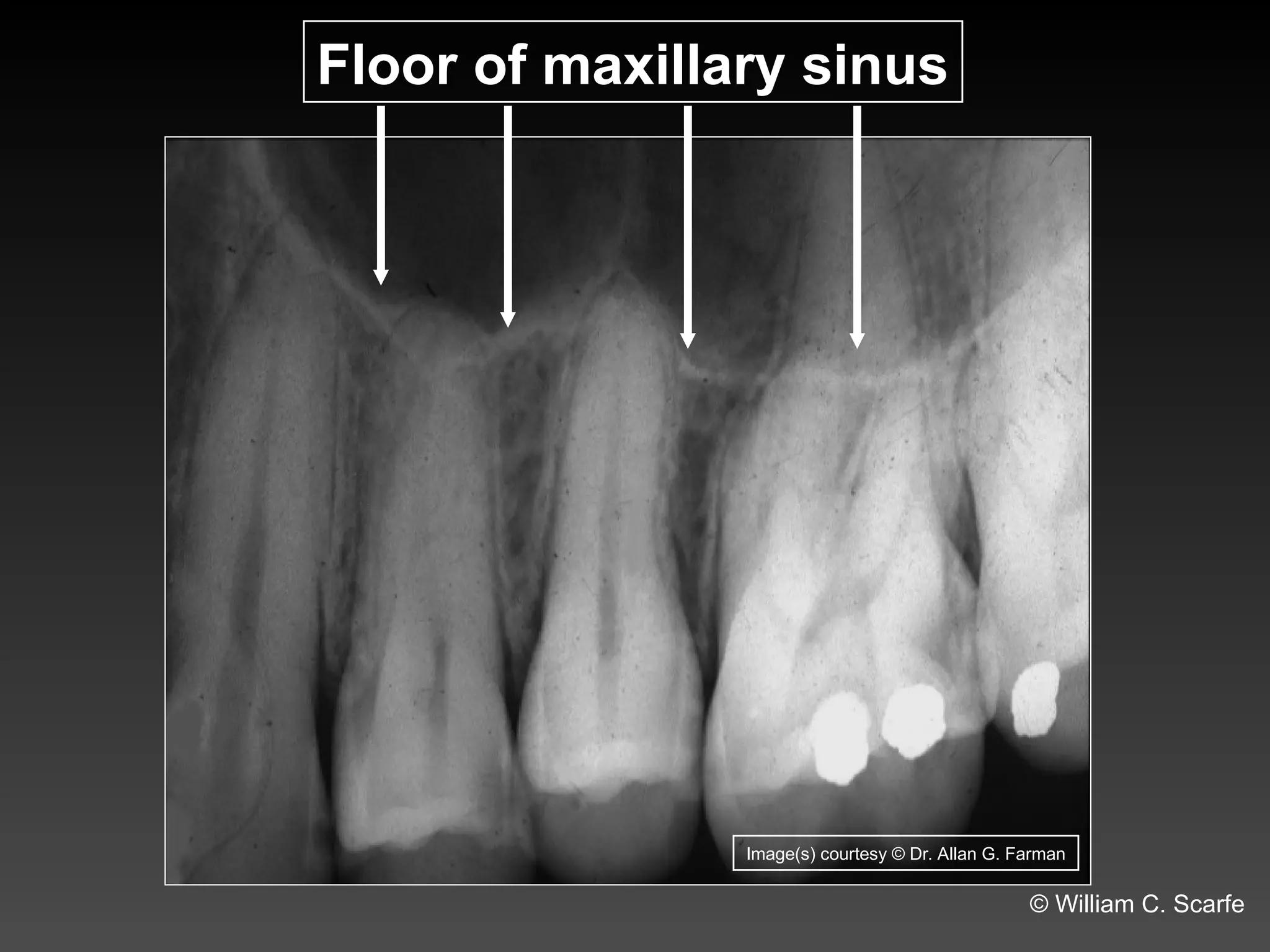 Dental Maxillary and Mandibular Anatomic Radiographic Landmarks.ppt | 3 ...