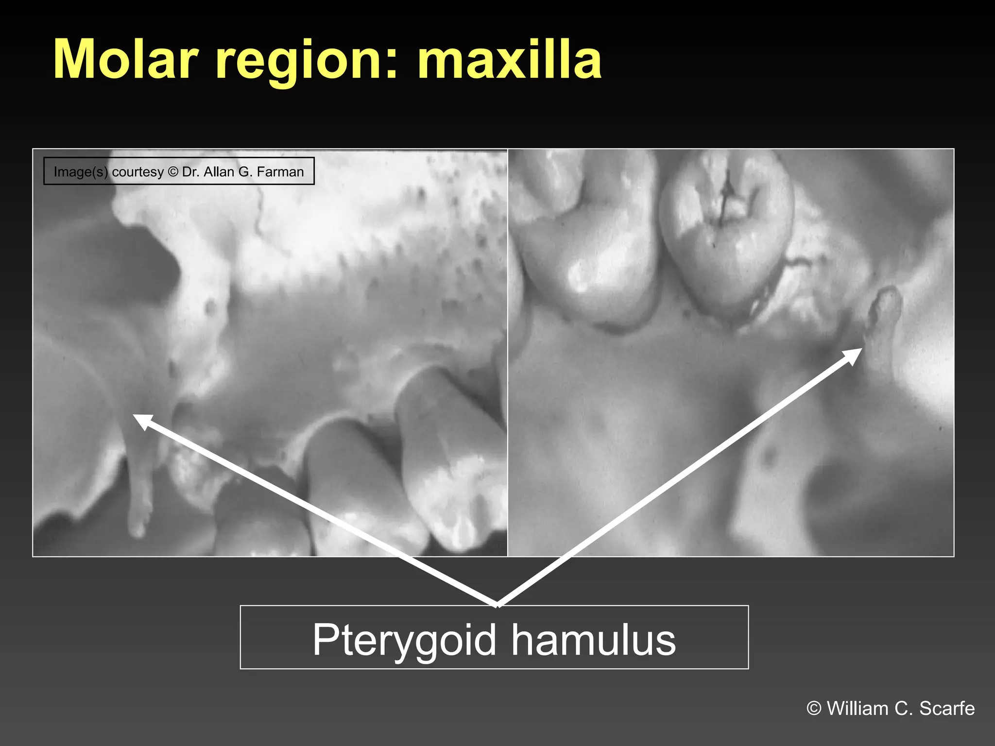 Dental Maxillary and Mandibular Anatomic Radiographic Landmarks.ppt