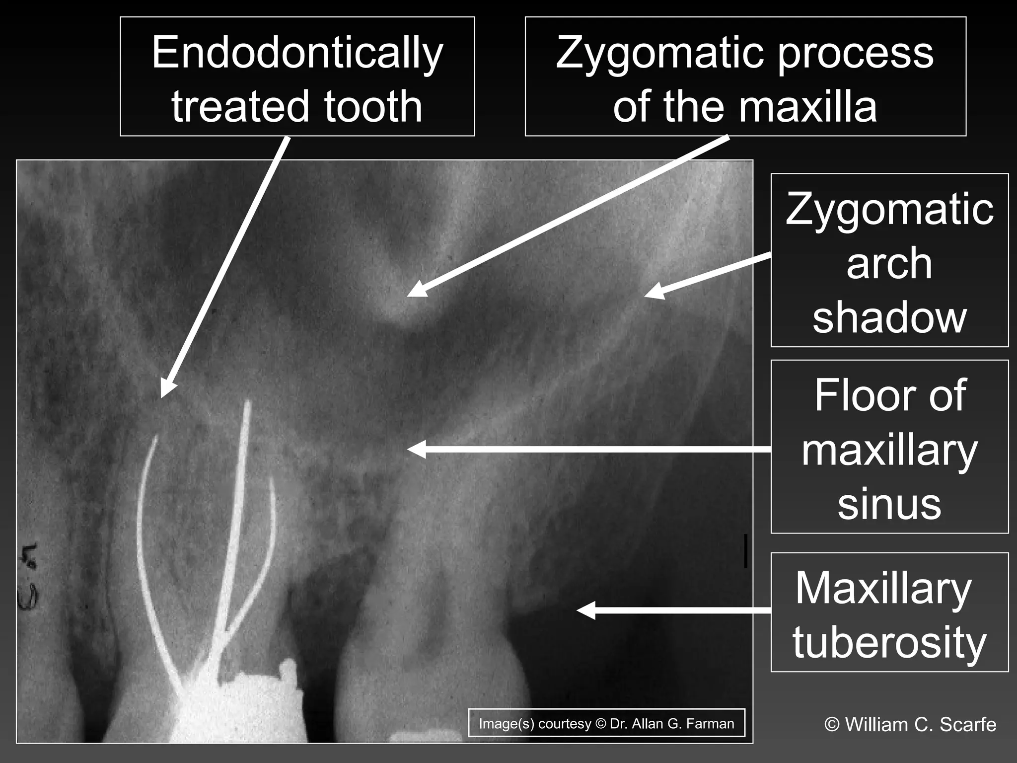Dental Maxillary and Mandibular Anatomic Radiographic Landmarks.ppt