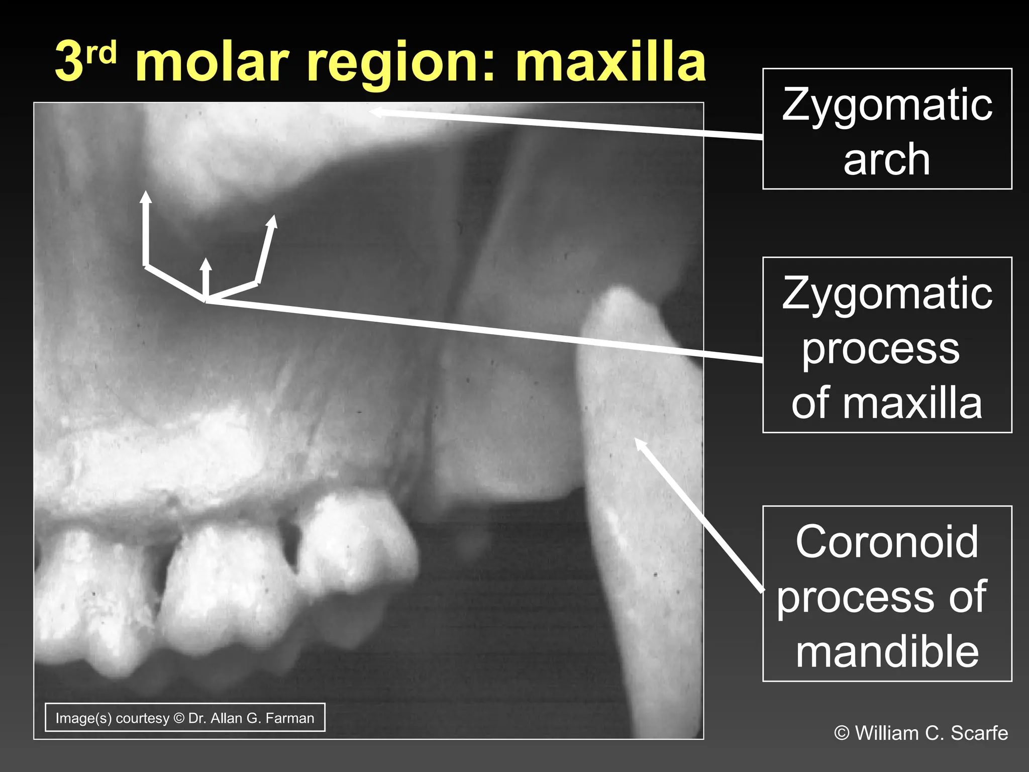 Dental Maxillary and Mandibular Anatomic Radiographic Landmarks.ppt