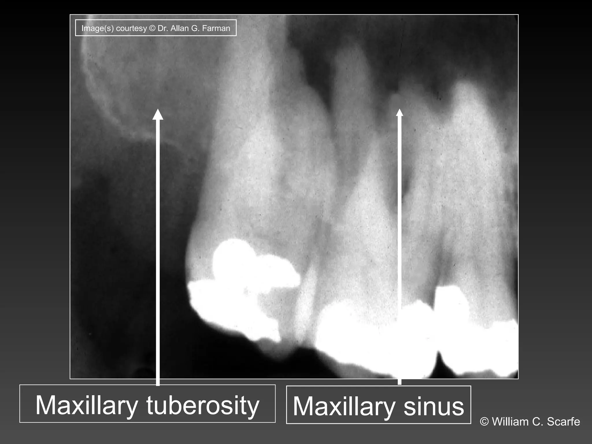 Dental Maxillary and Mandibular Anatomic Radiographic Landmarks.ppt