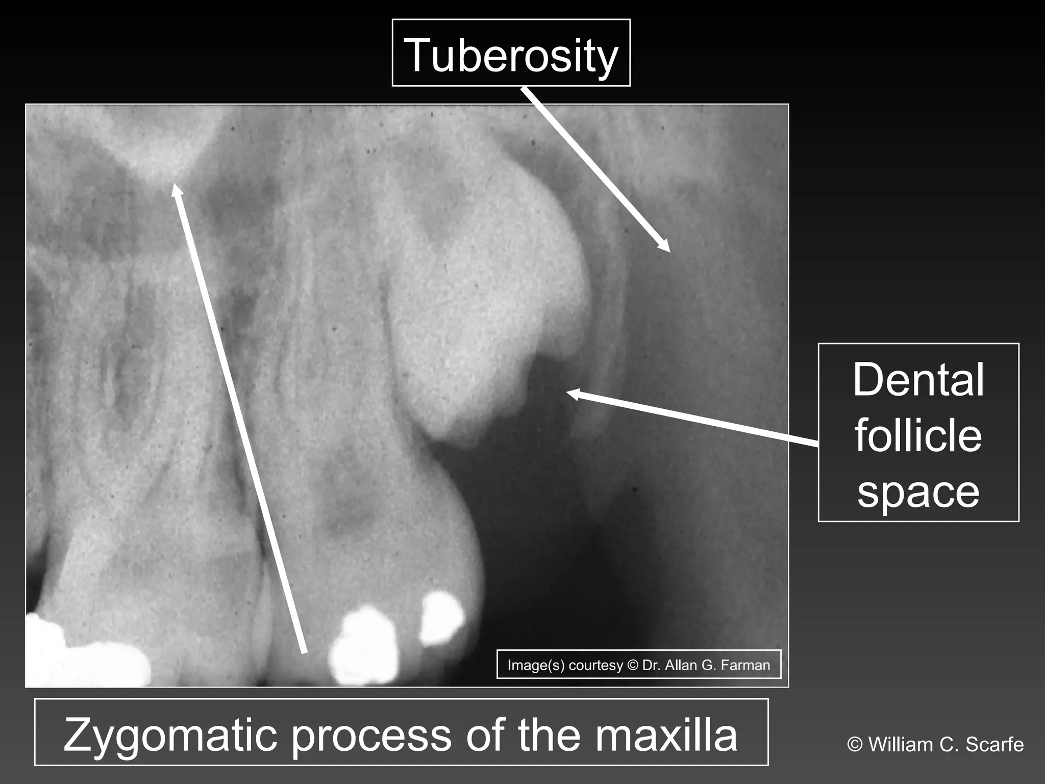 Dental Maxillary and Mandibular Anatomic Radiographic Landmarks.ppt | 3 ...