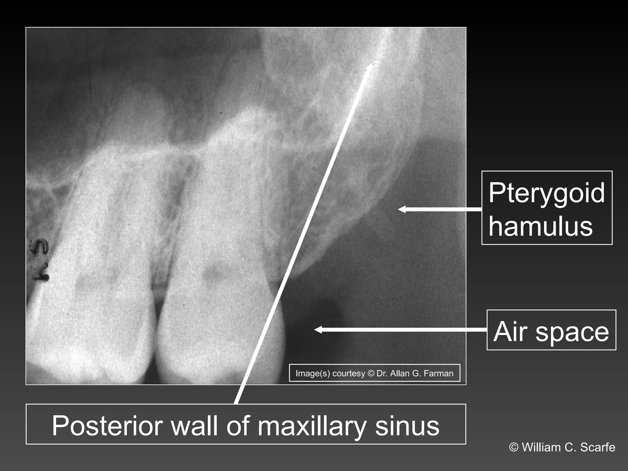 Dental Maxillary and Mandibular Anatomic Radiographic Landmarks.ppt