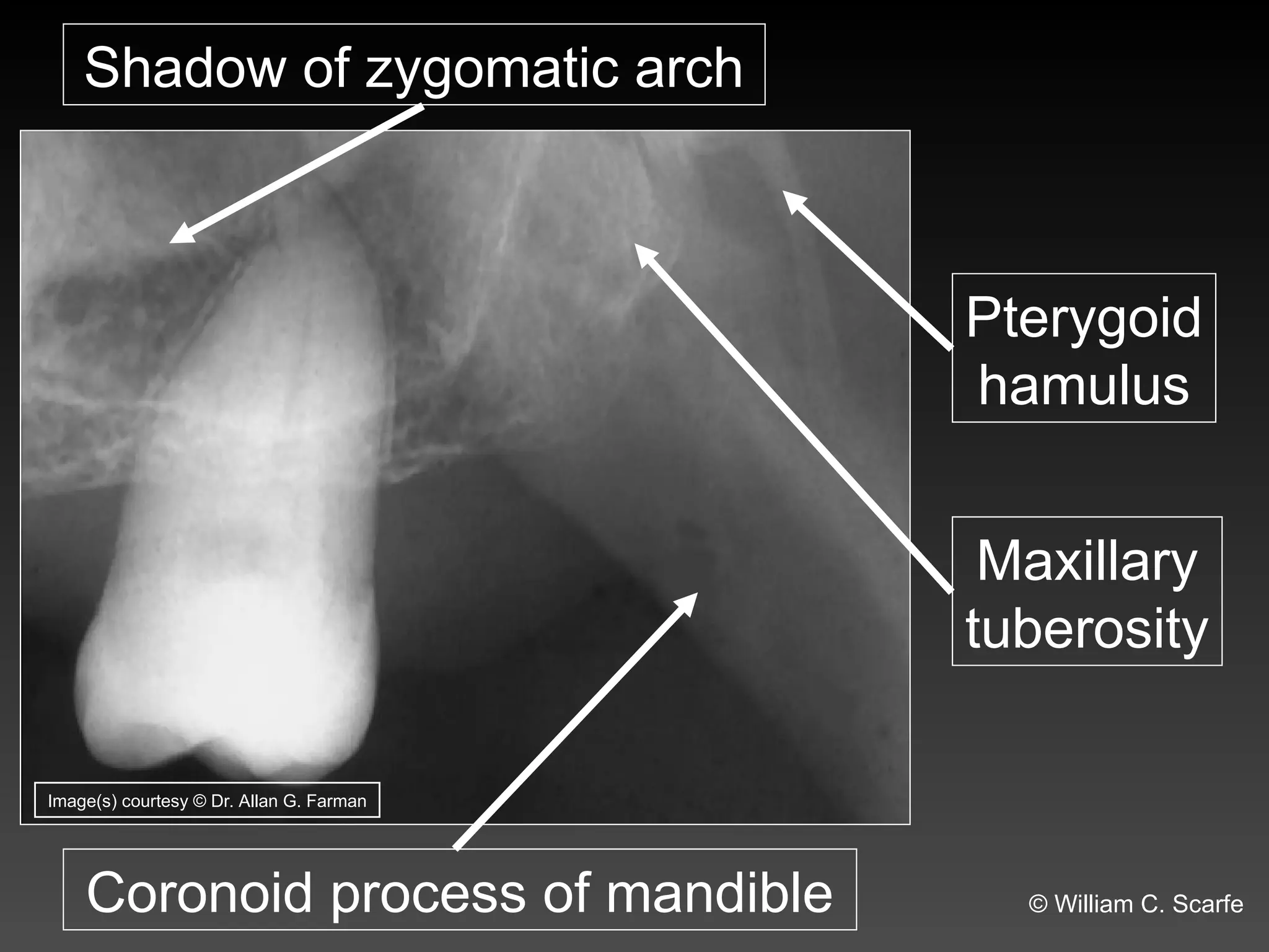 Dental Maxillary and Mandibular Anatomic Radiographic Landmarks.ppt | 3 ...
