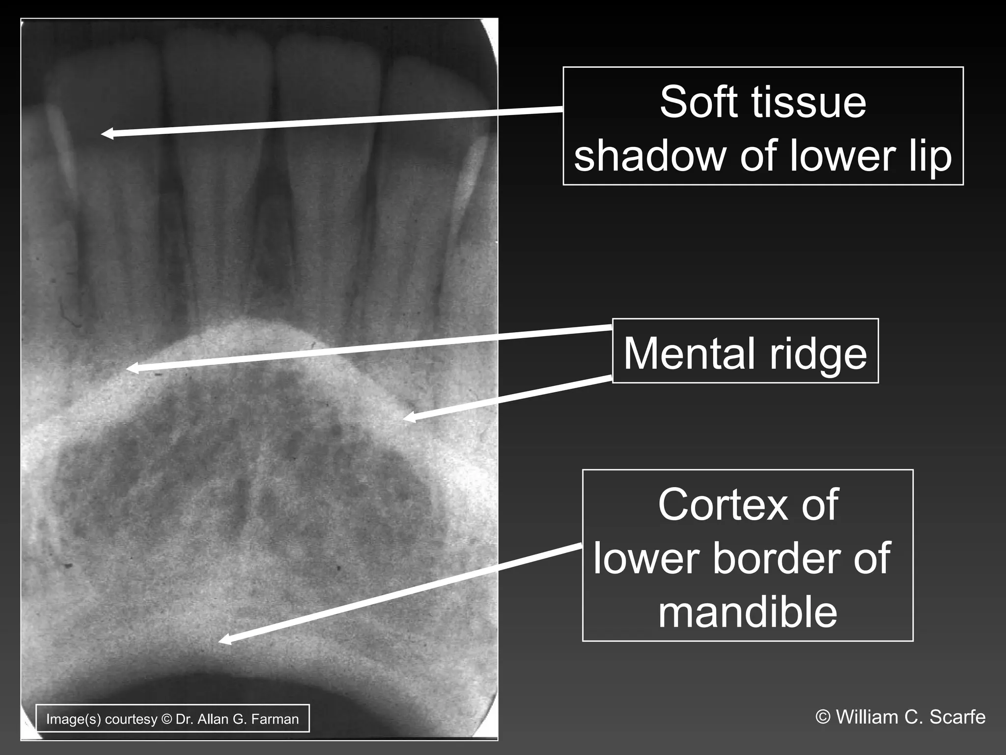 Dental Maxillary and Mandibular Anatomic Radiographic Landmarks.ppt