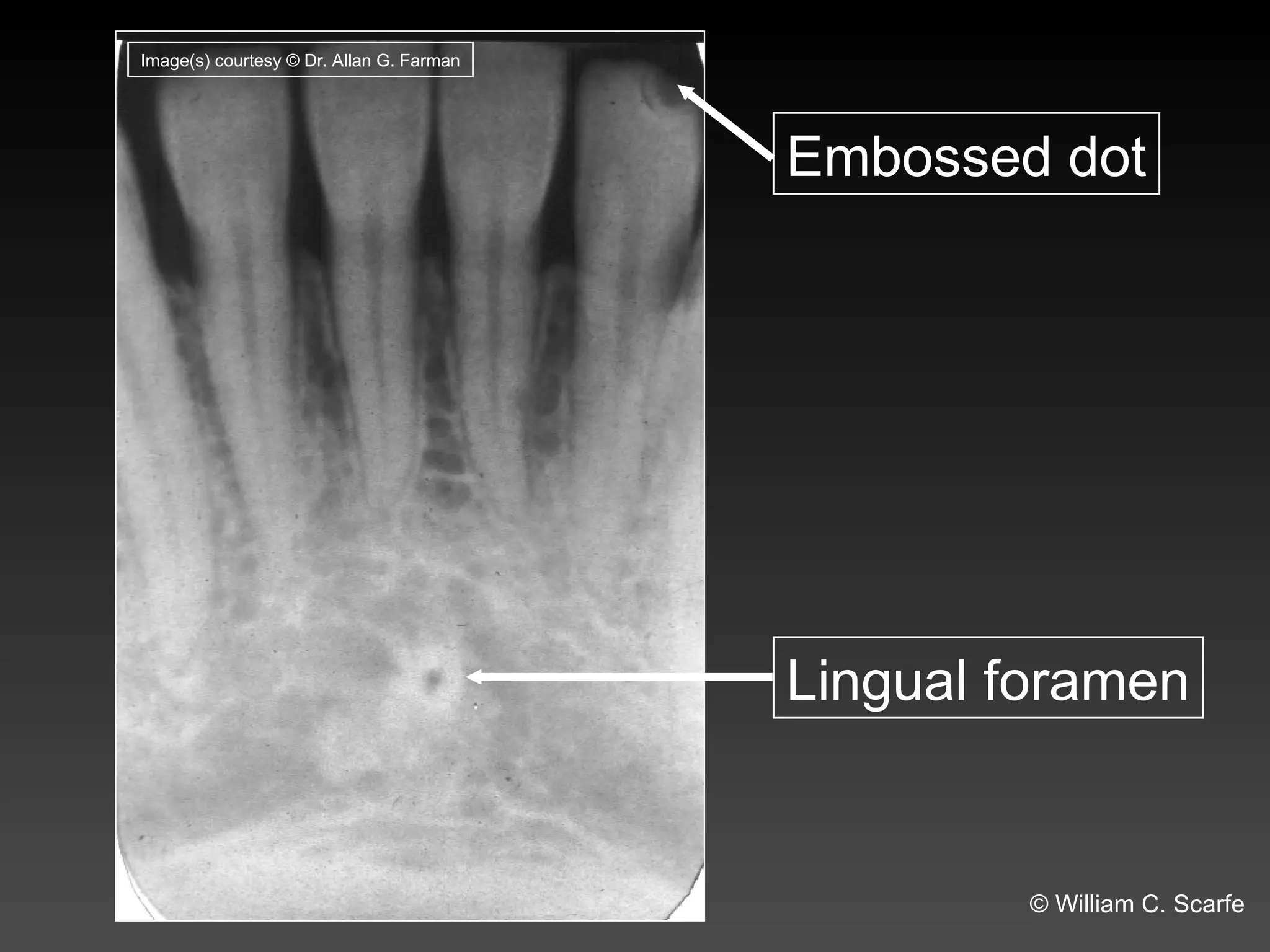 Dental Maxillary and Mandibular Anatomic Radiographic Landmarks.ppt