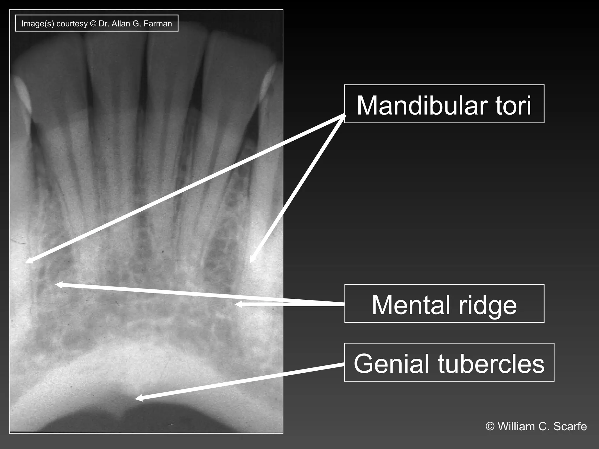 Dental Maxillary and Mandibular Anatomic Radiographic Landmarks.ppt