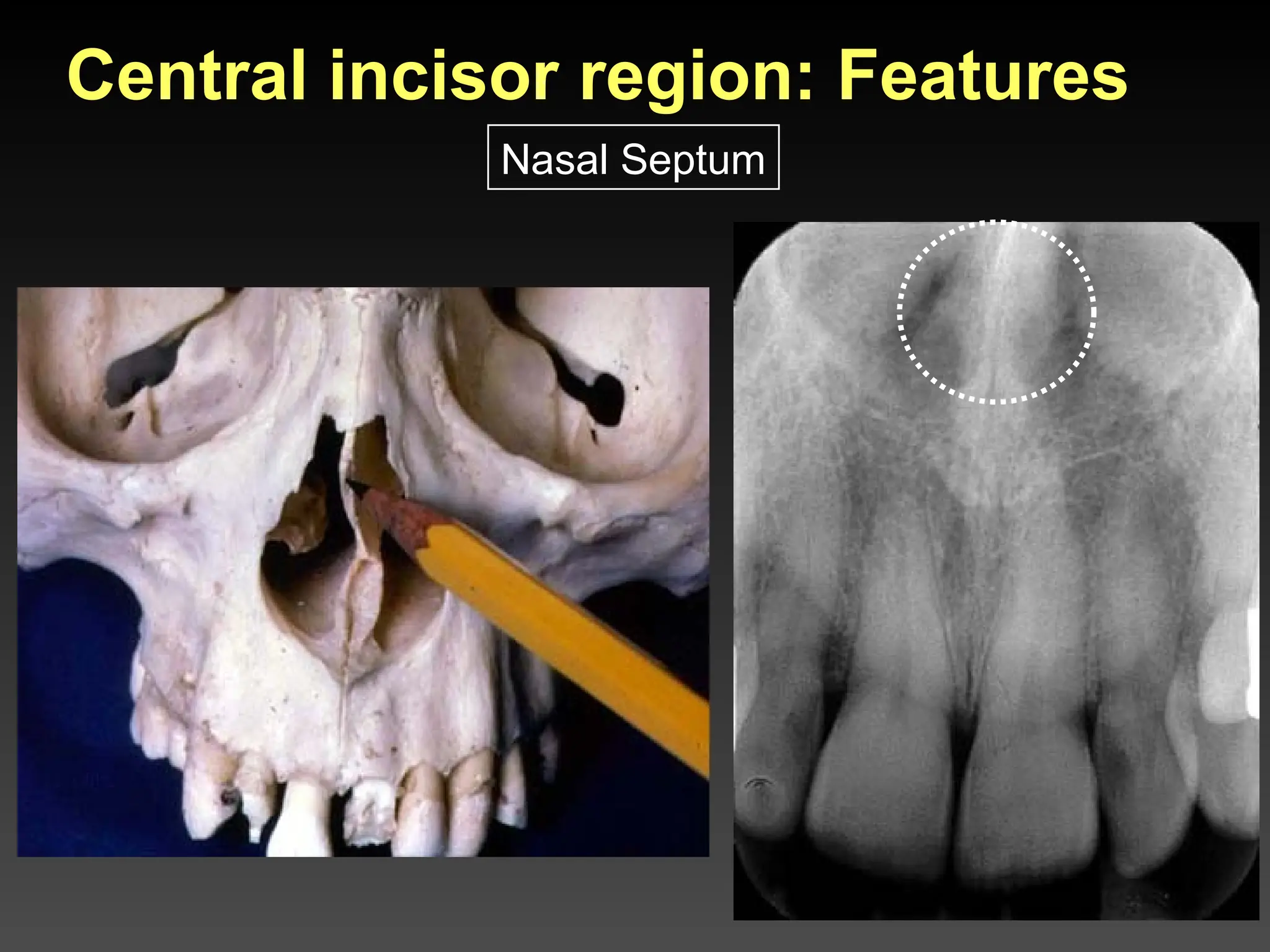Dental Maxillary and Mandibular Anatomic Radiographic Landmarks.ppt