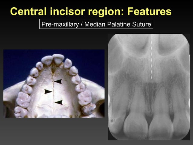 Dental Maxillary and Mandibular Anatomic Radiographic Landmarks.ppt | 3 ...