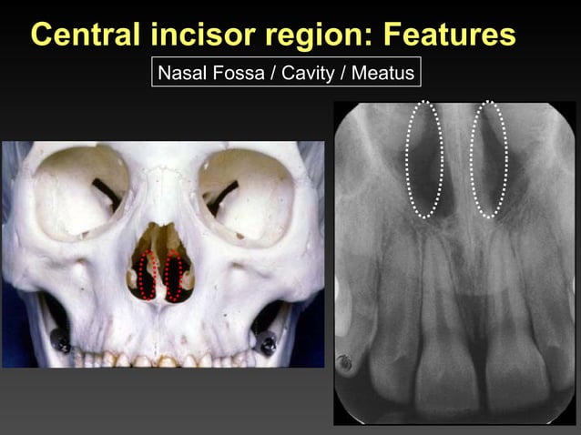 Dental Maxillary and Mandibular Anatomic Radiographic Landmarks.ppt | 3 ...