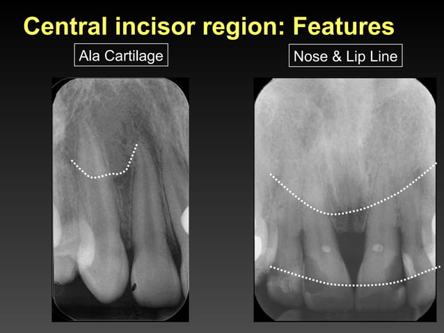 Dental Maxillary and Mandibular Anatomic Radiographic Landmarks.ppt | 3 ...