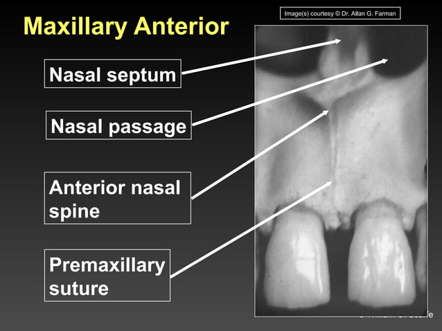 Dental Maxillary and Mandibular Anatomic Radiographic Landmarks.ppt | 3 ...