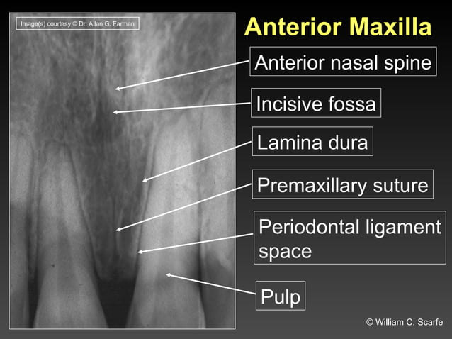 Dental Maxillary and Mandibular Anatomic Radiographic Landmarks.ppt | 3 ...