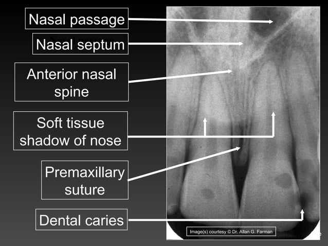 Dental Maxillary and Mandibular Anatomic Radiographic Landmarks.ppt | 3 ...