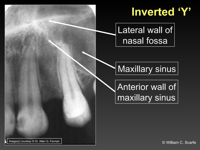Dental Maxillary and Mandibular Anatomic Radiographic Landmarks.ppt | 3 ...