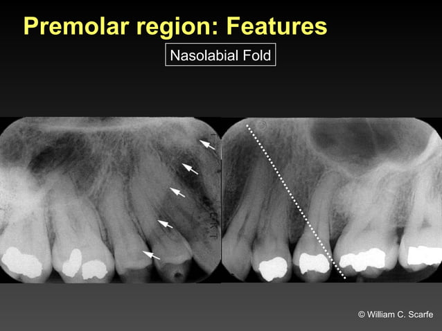 Dental Maxillary and Mandibular Anatomic Radiographic Landmarks.ppt | 3 ...