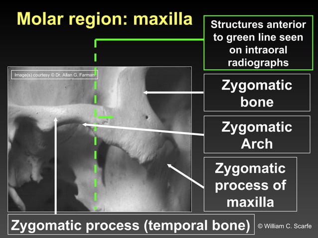 Dental Maxillary and Mandibular Anatomic Radiographic Landmarks.ppt | 3 ...