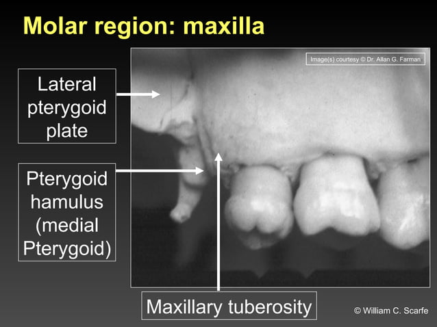 Dental Maxillary and Mandibular Anatomic Radiographic Landmarks.ppt | 3 ...