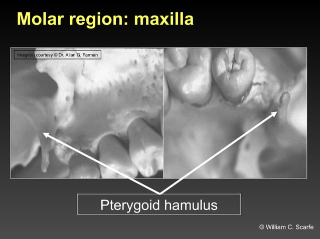 Dental Maxillary and Mandibular Anatomic Radiographic Landmarks.ppt | 3 ...