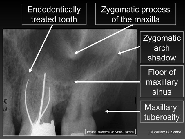 Dental Maxillary and Mandibular Anatomic Radiographic Landmarks.ppt | 3 ...