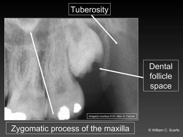 Dental Maxillary and Mandibular Anatomic Radiographic Landmarks.ppt | 3 ...