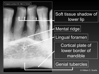 Dental Maxillary and Mandibular Anatomic Radiographic Landmarks.ppt