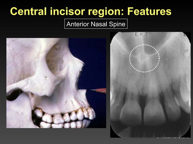 Dental Maxillary and Mandibular Anatomic Radiographic Landmarks.ppt | 3 ...