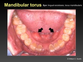 Dental Maxillary and Mandibular Anatomic Radiographic Landmarks.ppt