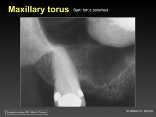 Dental Maxillary and Mandibular Anatomic Radiographic Landmarks.ppt