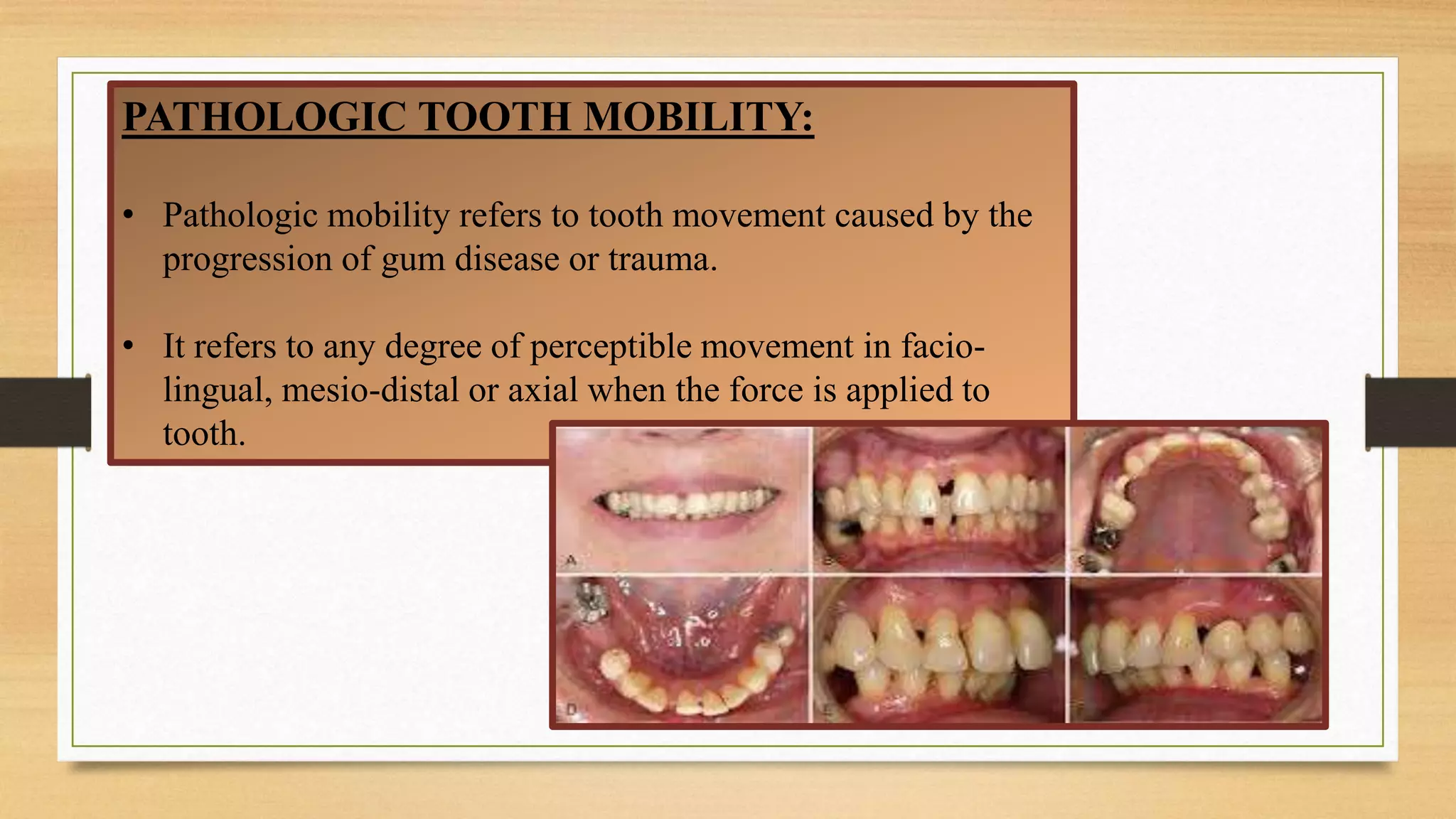 Dental mobility | PPTX