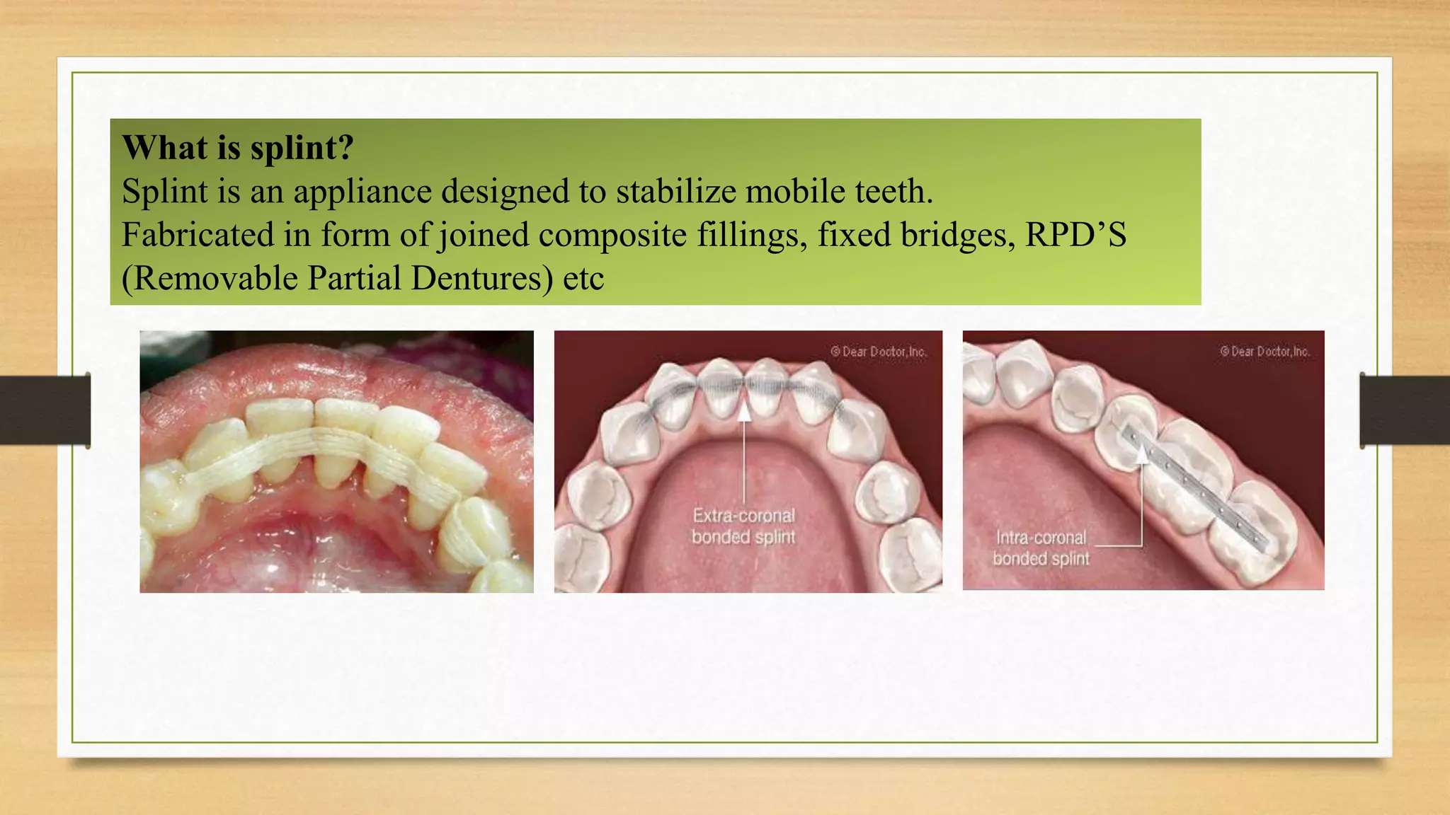 Dental mobility | PPTX