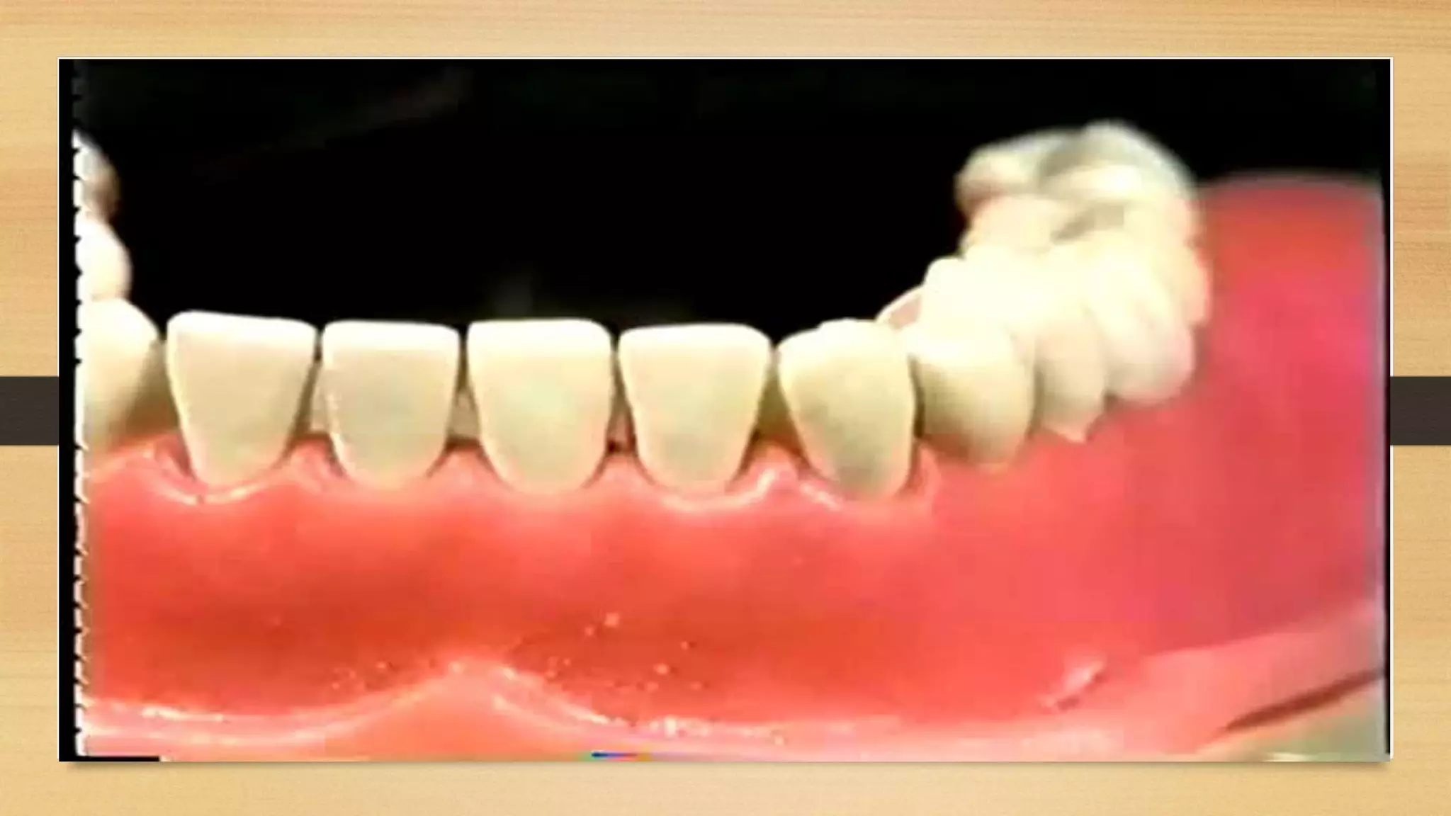 Dental mobility | PPTX