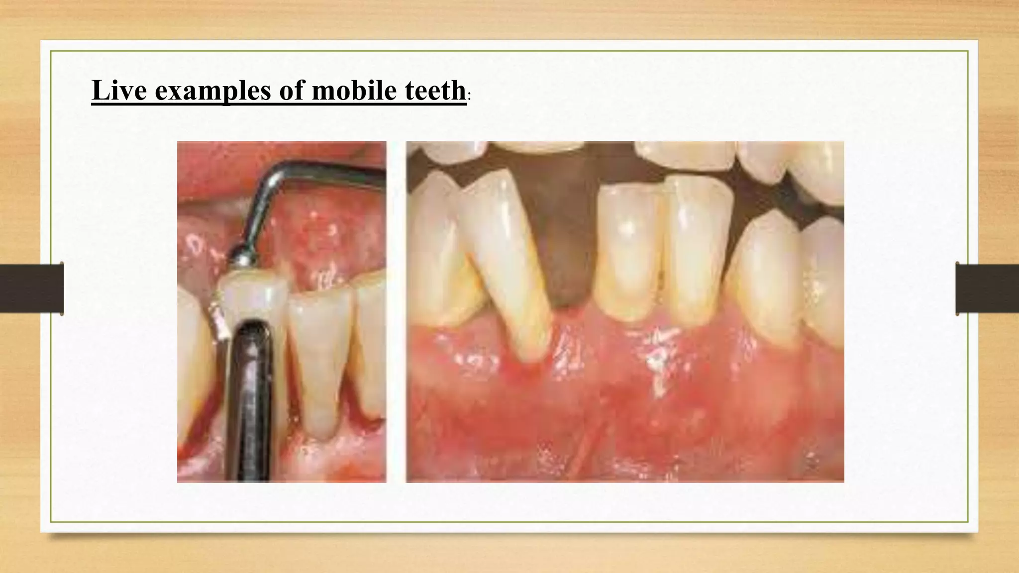 Dental mobility | PPTX
