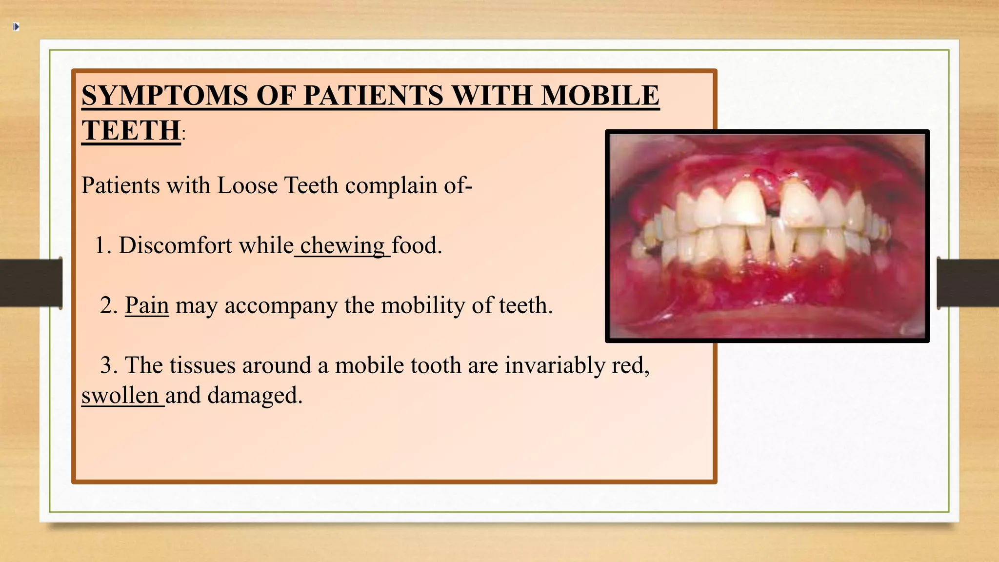 Dental mobility | PPTX