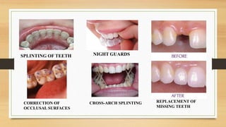 Dental mobility | PPTX