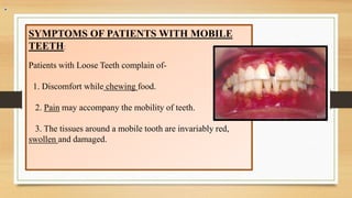 Dental mobility | PPTX