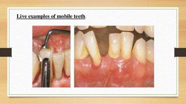 Dental mobility