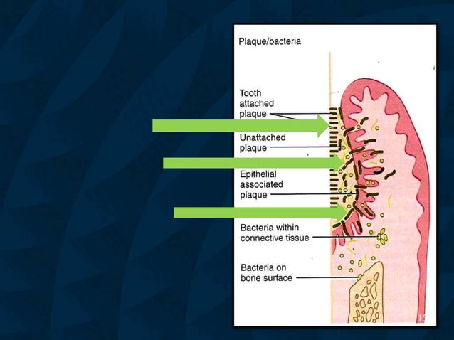 Dental Plaque | PPTX | Dental Health | Diseases and Conditions