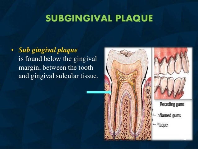 Dental Plaque