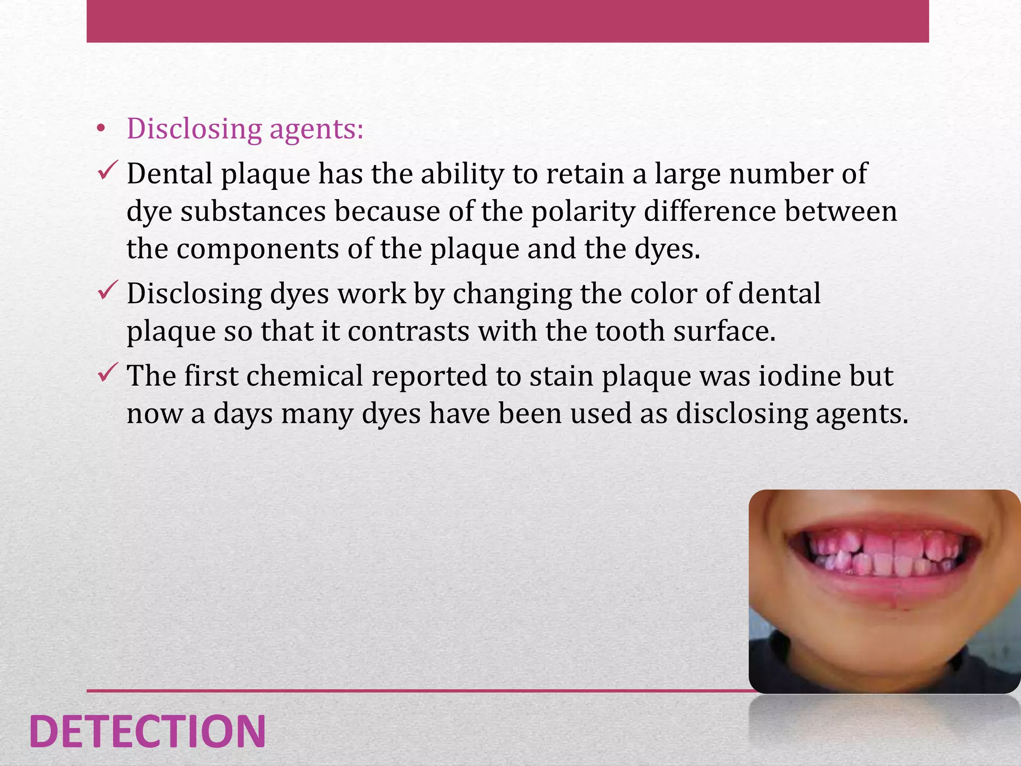 Dental plaque | PPTX