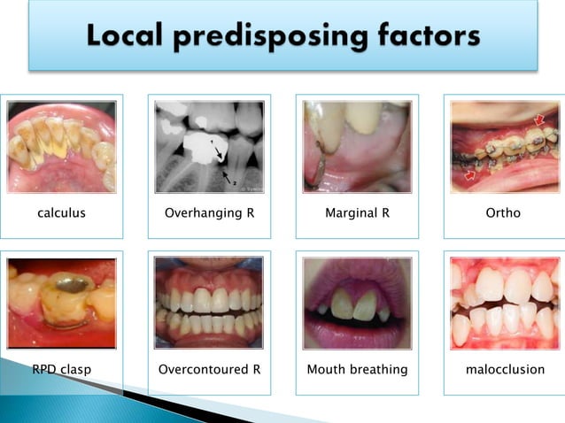 Dental plaque | PPTX