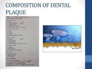 Dental plaque | PPTX