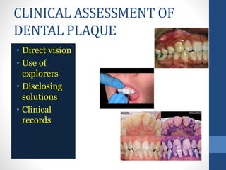Dental plaque | PPTX