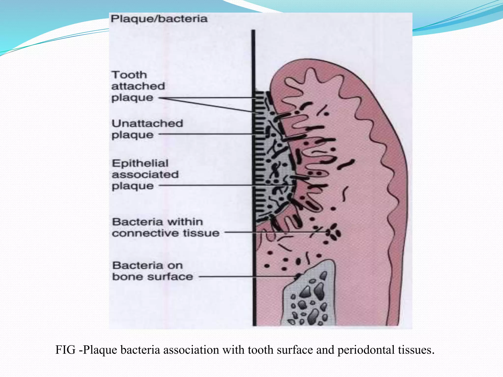 dental_plaque.pptx