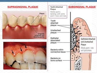 DENTAL PLAQUE - PART 1