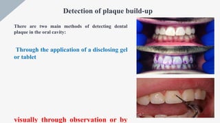 Dental Plaque Biofilm byDr. Mohammed.pptx