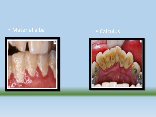 Dental plaque